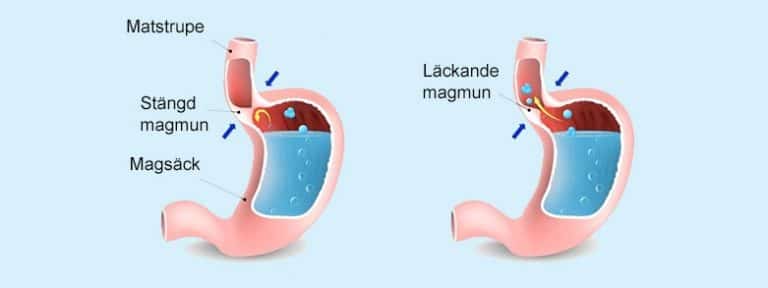 Vad är orsaken till halsbränna? - Halsbränna
